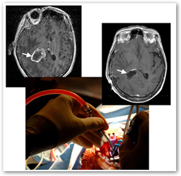 UCLA Scientists Create Army of Tumor Fighting Immune Cells and Watch As ...